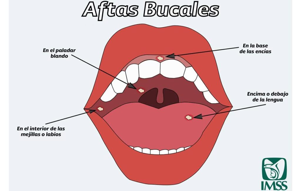 ¿Por Qué Salen Aftas En La Garganta? | SA Acupuntura