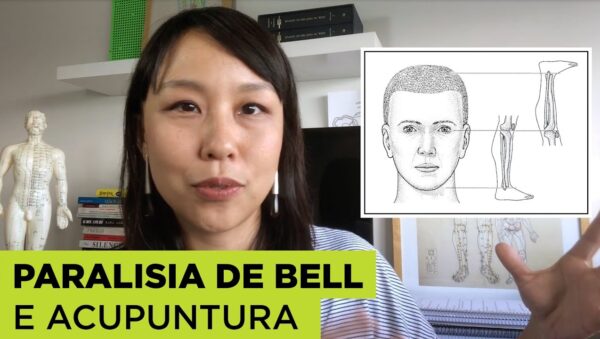 Acupuntura Y Parálisis De Bell Una Esperanza Sa Acupuntura