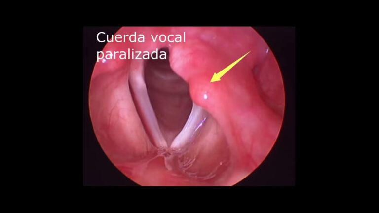 Recuperando La Voz Tratamiento De Cuerdas Vocales Paralizadas Sa